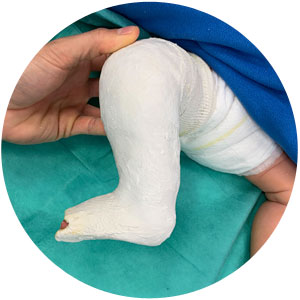 Klumpfuß – Ponseti Methode – Priv.-Doz. Dr. Christof Radler