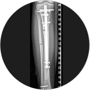 Limb Lengthening – Assoc. Prof. Christof Radler, MD